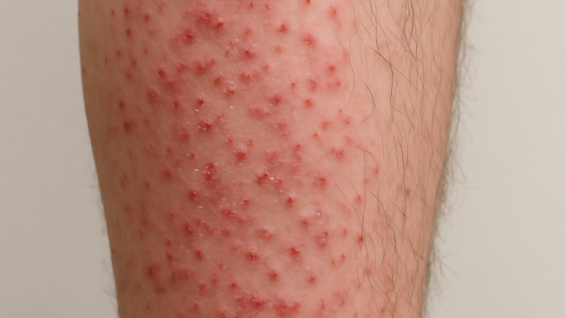 Follicular Eczema Causes & Top Treatments Today