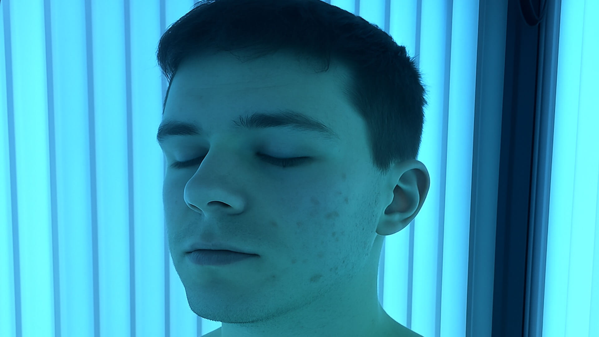 Do Sunbeds Help Acne Or Worsen It? Risks Explained
