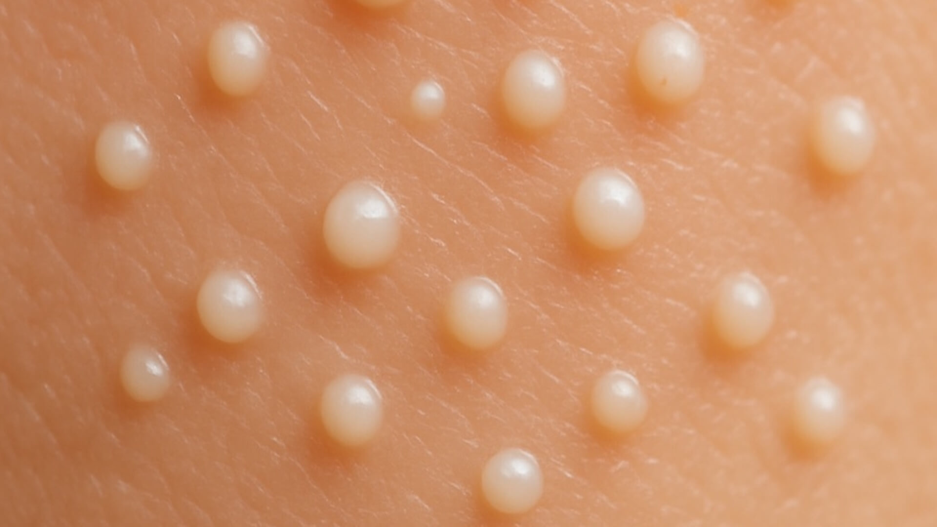 What Causes Milia Spots & How To Treat It Effectively