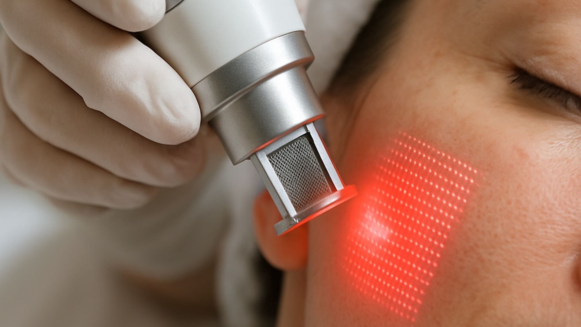 How Fractional Laser Can Renew Damaged Skin